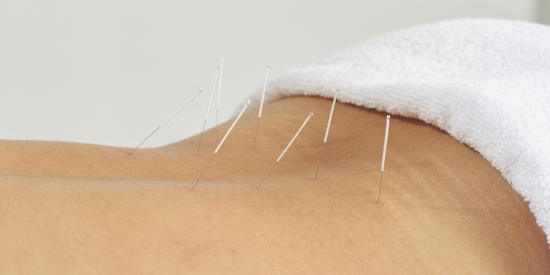 Benefits of Acupuncture for Sciatica | Dr. Lester Chiropractic